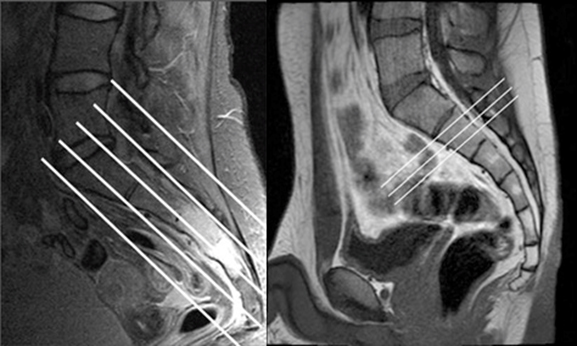 MR Lumbosacral Plexus WO or WWO MSK Protocol | OHSU